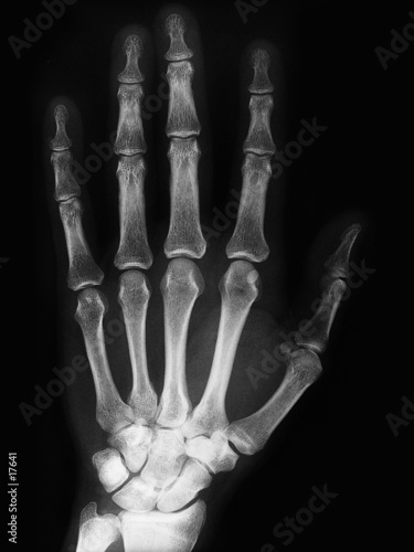 "radiographie d'une main gauche" photo libre de droits sur la banque d ...