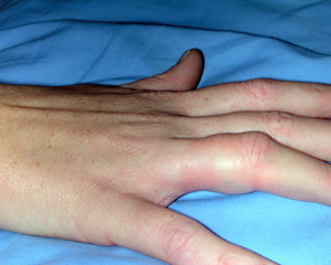 "hand Injury" photos, royalty-free images, graphics, vectors & videos ...