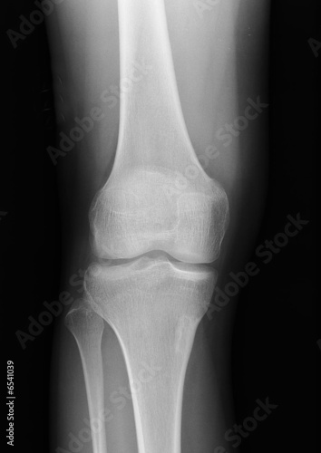 "Radio de genou de face" photo libre de droits sur la banque d'images ...