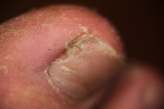 Fusspilz Images – Browse 73 Stock Photos, Vectors, and Video | Adobe Stock