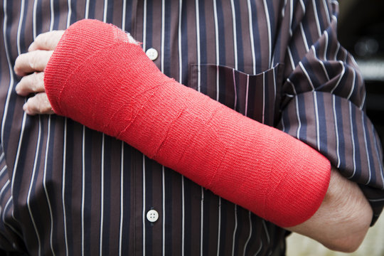 Gipsarm Bilder – Durchsuchen 135 Archivfotos, Vektorgrafiken und Videos ...