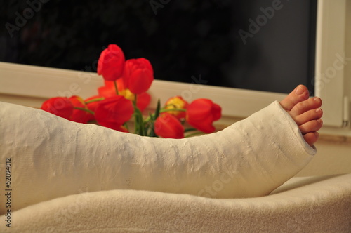 "Gipsbein im Krankenhaus" Stockfotos und lizenzfreie Bilder auf Fotolia ...