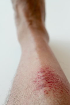 Basaliom bilder – Bläddra bland 664 stockfoton, vektorer och videor ...