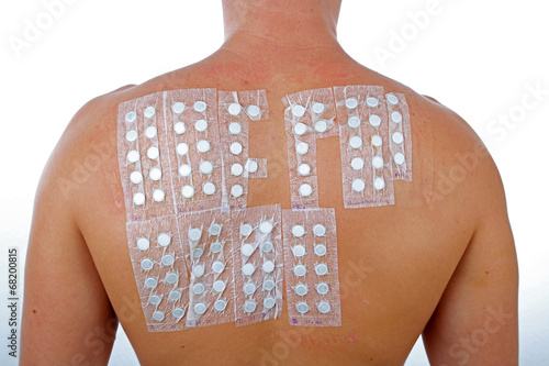 "Allergietest auf dem Rücken" Stockfotos und lizenzfreie Bilder auf ...