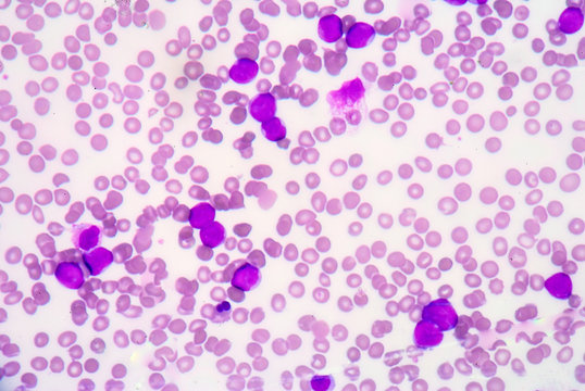 รูปภาพMetamyelocyte – เลือกดูภาพถ่ายสต็อก เวกเตอร์ และวิดีโอ142 | Adobe ...