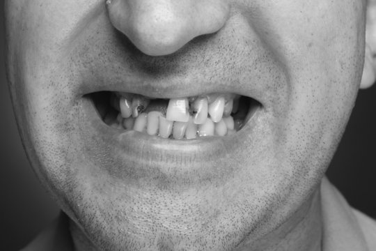 Mundkrebs Bilder – Durchsuchen 12,866 Archivfotos, Vektorgrafiken und ...