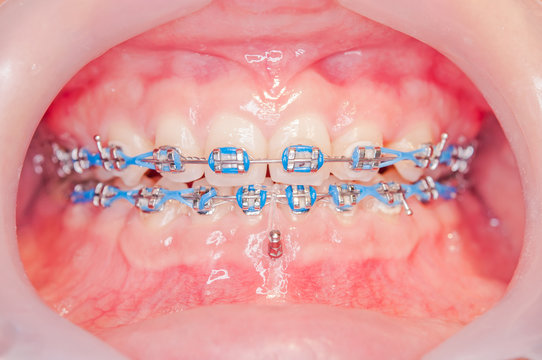 Microimplant Images – Browse 12 Stock Photos, Vectors, and Video ...