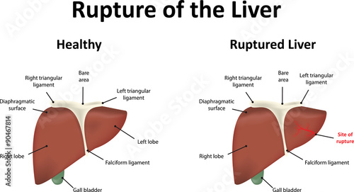 "Ruptured Liver" Stock photo and royalty-free images on Fotolia.com ...