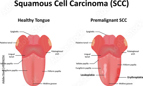 "Squamous Cell Carcinoma of the Tongue" Imagens e fotos de stock ...