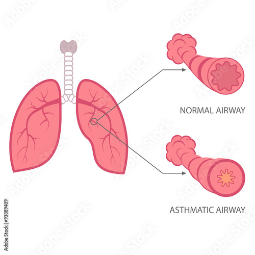 Asthma Lungs Animation