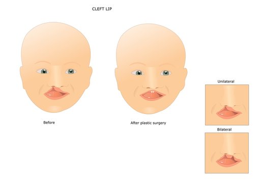 รูปภาพHarelip – เลือกดูภาพถ่ายสต็อก เวกเตอร์ และวิดีโอ493 | Adobe Stock