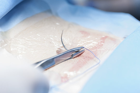 17,948 BESTE Bauchoperation BILDER, STOCK-FOTOS & -VEKTORGRAFIKEN ...