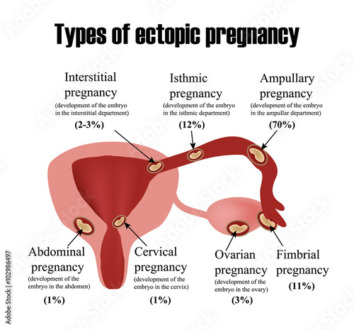 "Types of ectopic pregnancy. Infographics. Vector illustration on ...