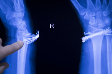 "hand Injury" photos, royalty-free images, graphics, vectors & videos ...