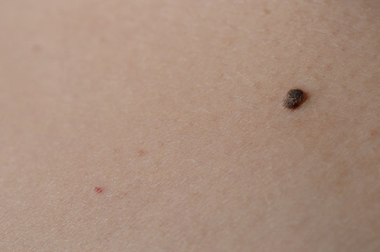 「Leberfleck」の写真素材 | 107件の無料イラスト画像 | Adobe Stock