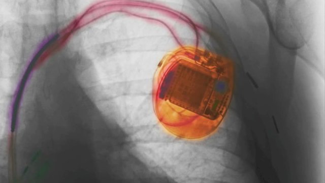 Pacemaker Images – Browse 97,975 Stock Photos, Vectors, and Video ...