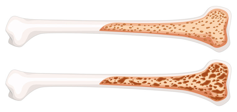 "Bone Density" Images – Browse 1,392 Stock Photos, Vectors, and Video ...