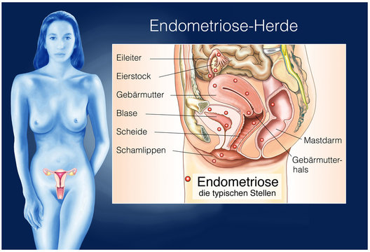 Endometriose bilder – Bläddra bland 50 stockfoton, vektorer och videor | Adobe Stock