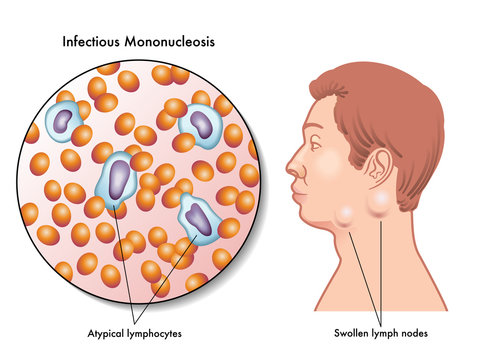 Swollen Lymph Nodes Diagram