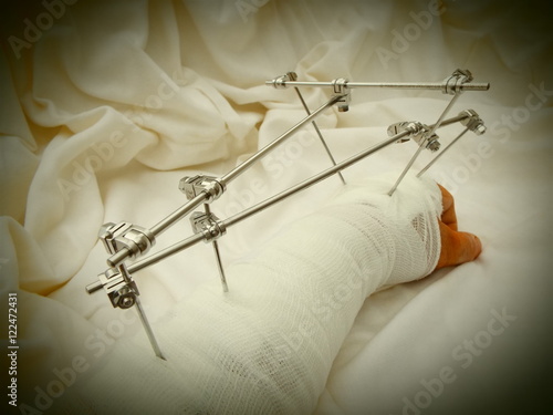 "Fixateur externe" Stockfotos und lizenzfreie Bilder auf Fotolia.com - Bild 122472431