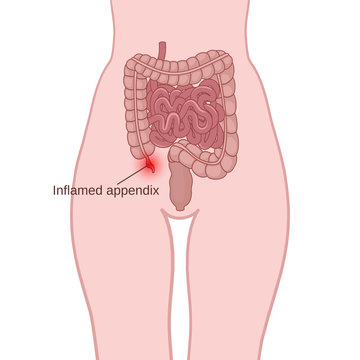 Appendix Location Female