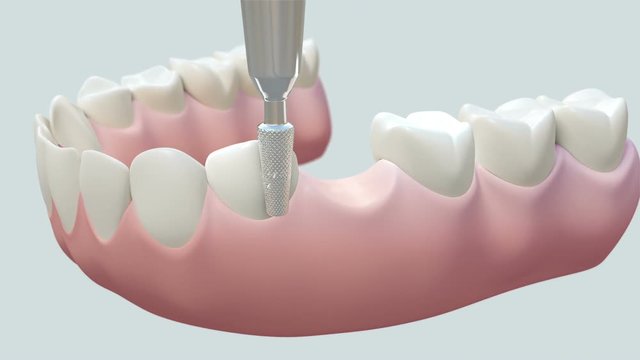 Dental Bridge Images – Browse 561,878 Stock Photos, Vectors, and Video ...