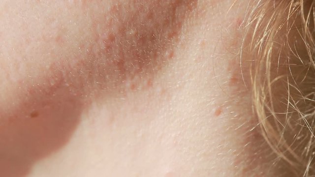 รูปภาพWhiteheads – เลือกดูภาพถ่ายสต็อก เวกเตอร์ และวิดีโอ29,723 | Adobe ...