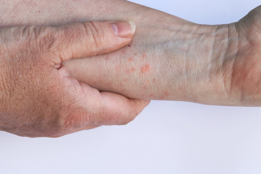 「Pusteln」の写真素材 | 82件の無料イラスト画像 | Adobe Stock