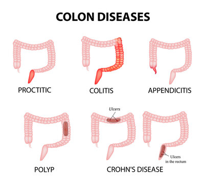 รูปภาพProctosigmoiditis – เลือกดูภาพถ่ายสต็อก เวกเตอร์ และวิดีโอ19 ...