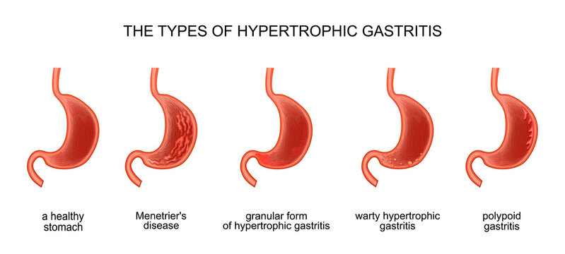 รูปภาพGastritis – เลือกดูภาพถ่ายสต็อก เวกเตอร์ และวิดีโอ16,397 | Adobe ...