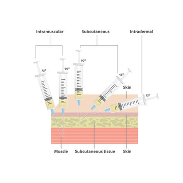 Intradermal Injection Needle Size