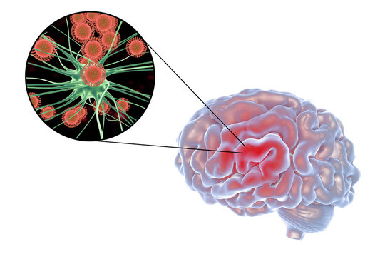 Neuroinfection Images – Browse 56 Stock Photos, Vectors, and Video ...