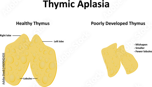 "Thymic Aplasia" Stock photo and royalty-free images on Fotolia.com ...