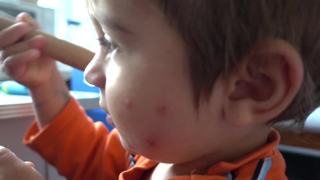 Furunculus Imagens – Procure 17 fotos, vetores e vídeos | Adobe Stock