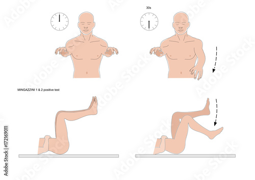 "A neurological examination: the Mingazzini 1 and 2 test (positive ...