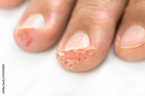 "Advanced stage of dyshidrosis on fingers,cracked and peeling skin ...