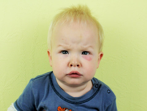 Mosquito Bite Allergy Eye