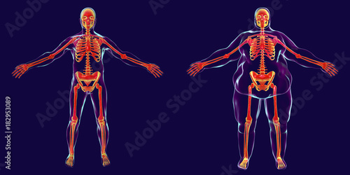 "Obesity problem conceptual image, 3D illustration showing normal ...