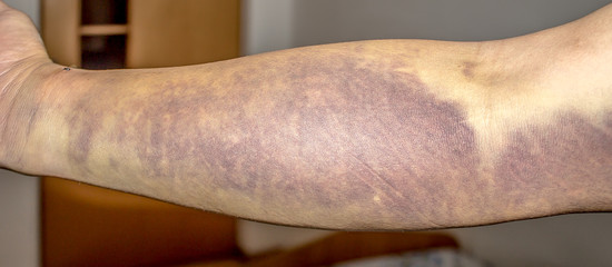 Search photos hematoma