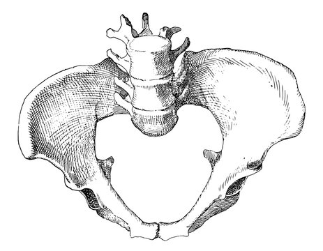 Rachitic Pelvis