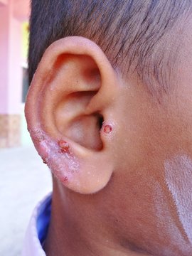 Fungal Infection Behind Ear