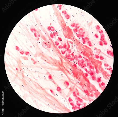 "Smear of Gram's stained from sputum specimen with gram positive cocci ...