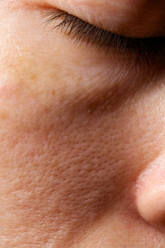 Pimles Images – Browse 8 Stock Photos, Vectors, and Video | Adobe Stock