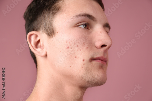 "Young man with acne problem on color background" Stock photo and ...