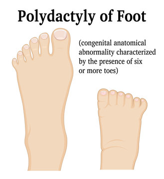 71 MEILLEURES Polydactylie IMAGES, PHOTOS ET ILLUSTRATIONS VECTORIELLES ...
