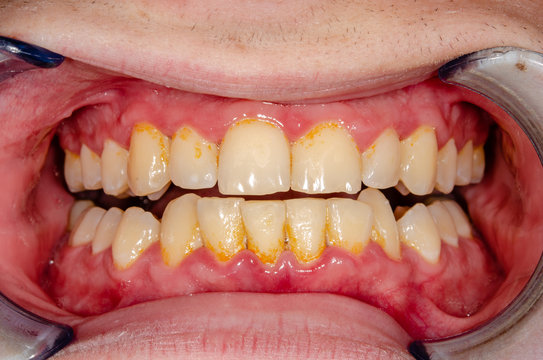 Zahnstein Bilder – Durchsuchen 178,328 Archivfotos, Vektorgrafiken und ...