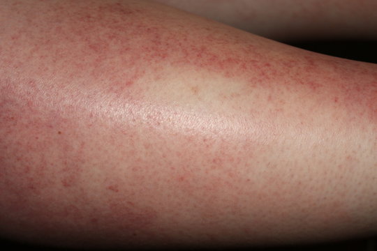 Photodermatitis Images – Browse 337 Stock Photos, Vectors, and Video ...