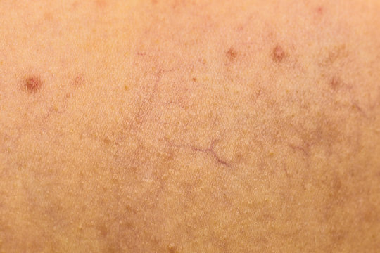 Dermatoses : photos, illustrations, vecteurs et vidéos libres de droits ...