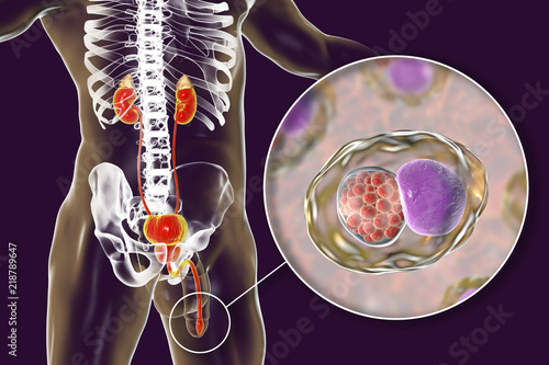 "Chlamydiosis infection in man, 3D illustration showing close-up view ...