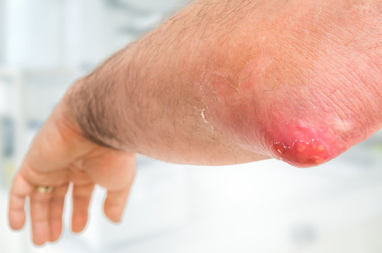 「Furunculus」の画像 - 16 件の Stock 写真、ベクターおよびビデオ | Adobe Stock